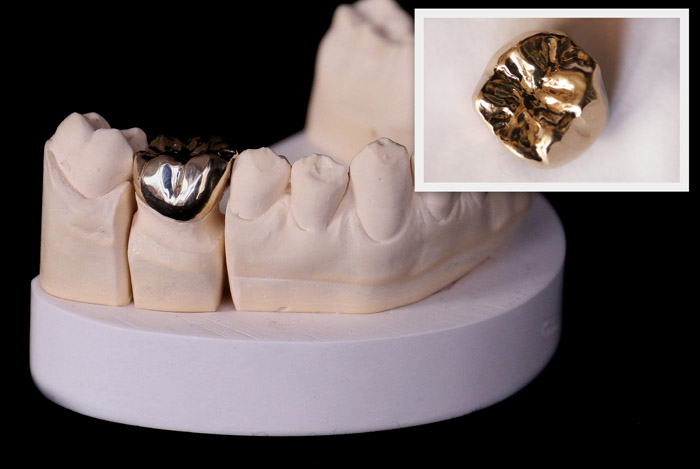 Crown and Bridge Service | Hughes Dental Laboratory