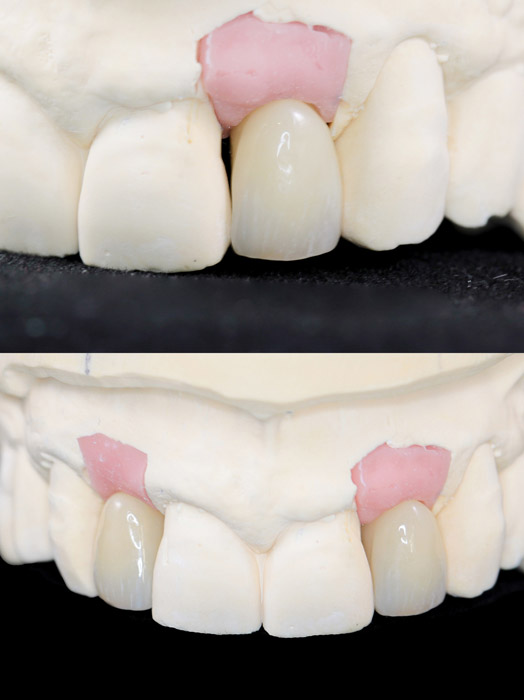 Our Implant Services | Hughes Dental Laboratories