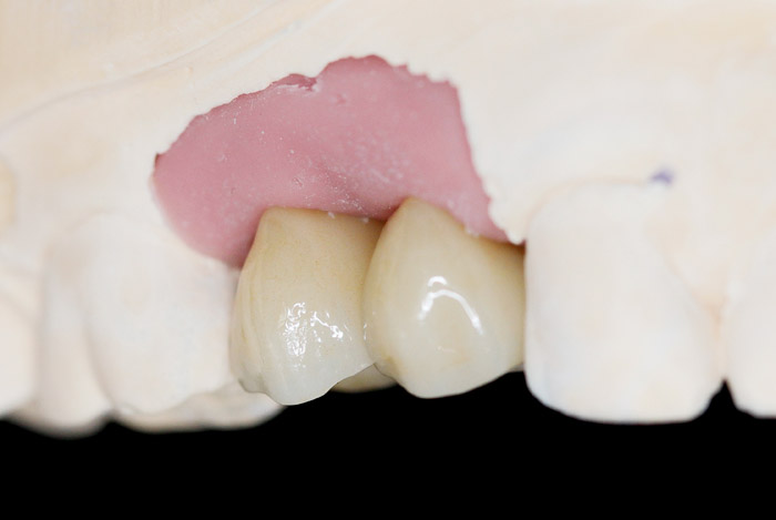 Our Implant Services | Hughes Dental Laboratories