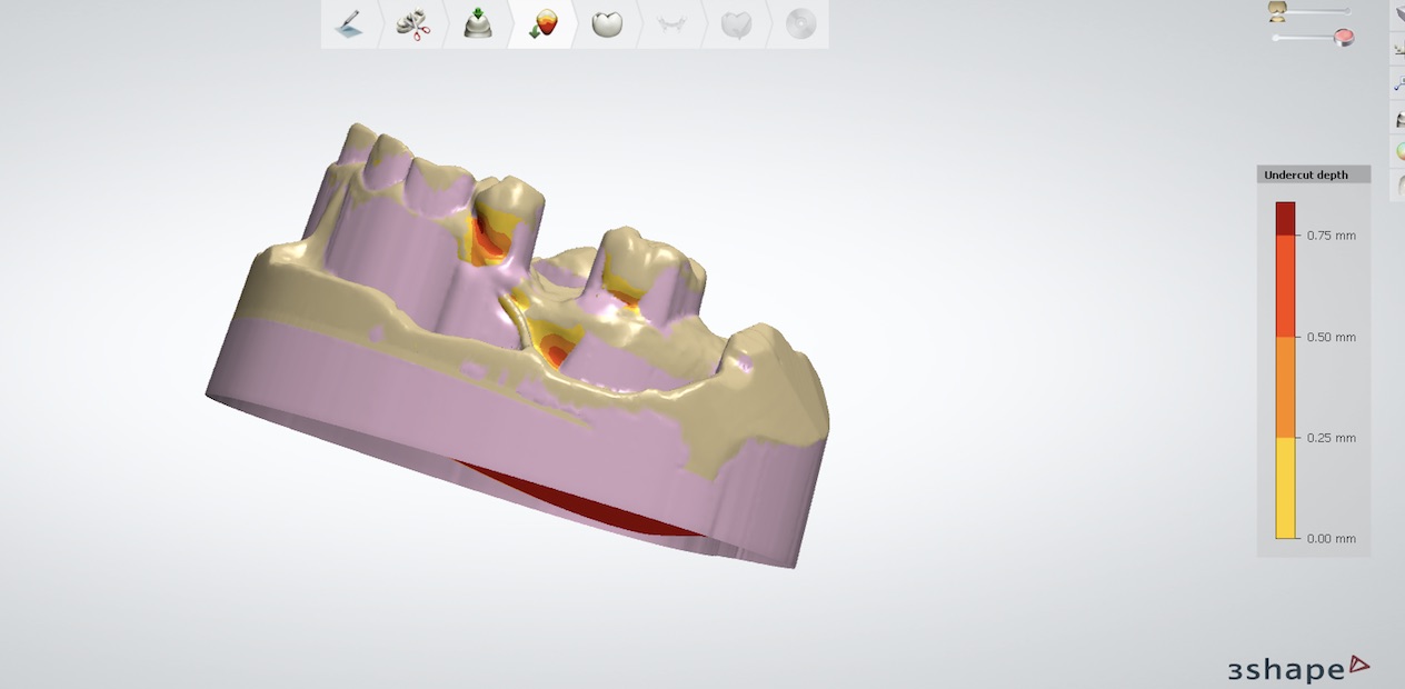 Full digital flexibles - Hughes Dental Laboratory
