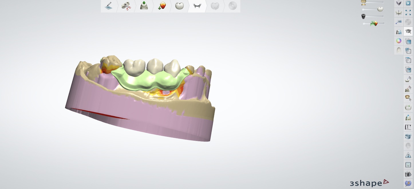 Full digital flexibles - Hughes Dental Laboratory